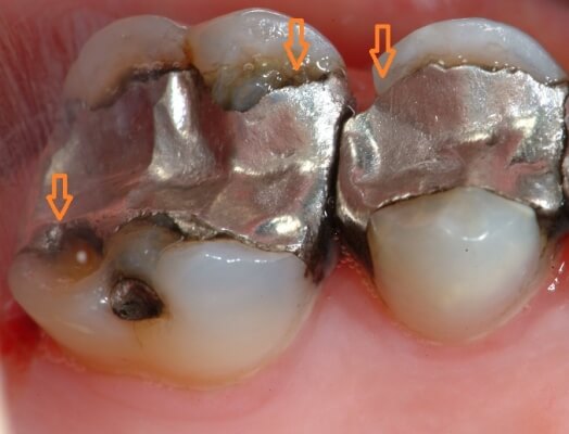 Should Silver Fillings be Replaced? | beverlyhillsladentist.com