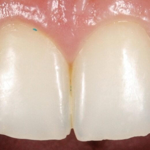 Biomimetic Dentistry & the tooth cycle of death