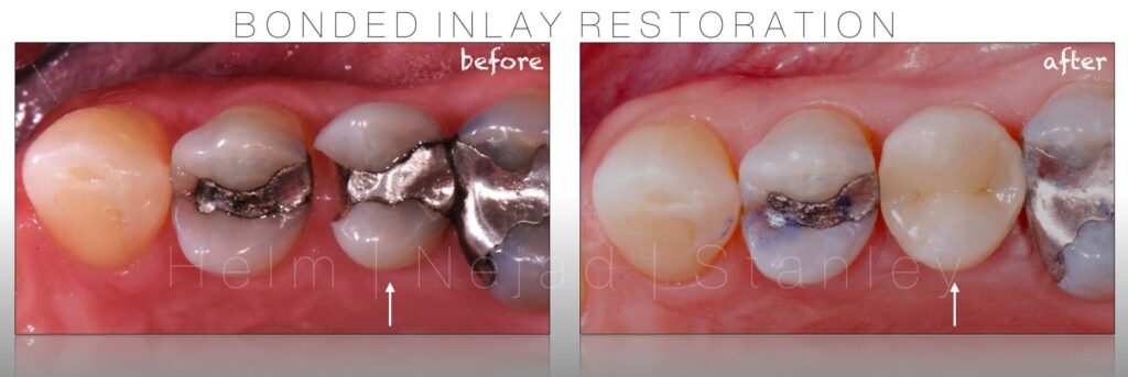Biomimetic Dentistry Before and After Photos | Helm Nejad Stanley