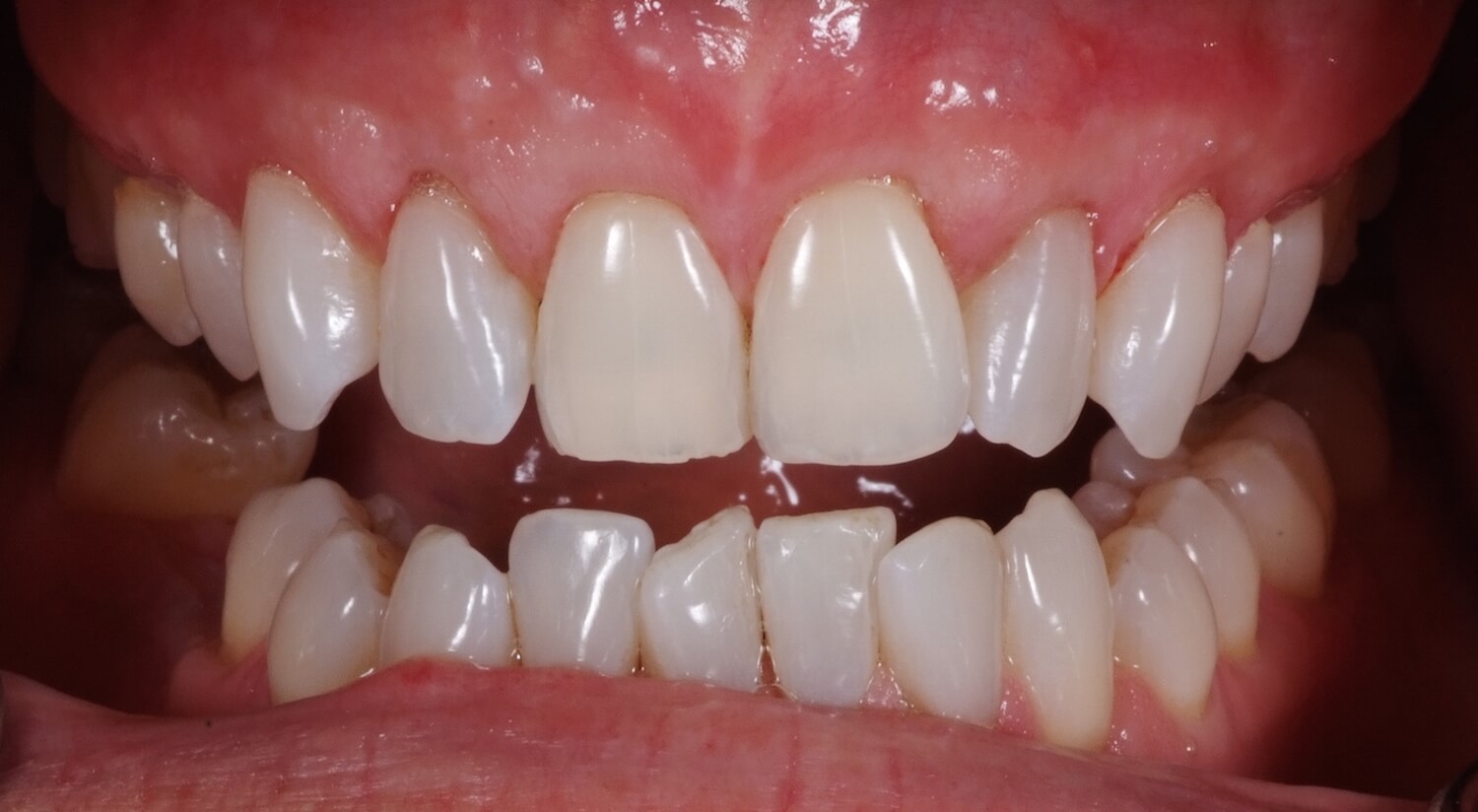 What Causes Gum Recession? - Causes, Prevention, and Treatments