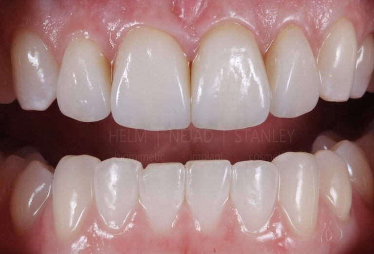 The Perfect Smile - Imperfection is Key | Beverly Hills Dentists