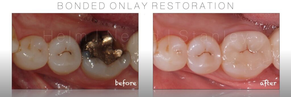 Biomimetic Dentistry Before and After Photos | Helm Nejad Stanley