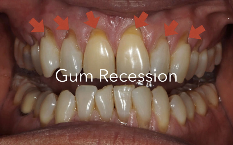 What Causes Gum Recession? - Causes, Prevention, and Treatments