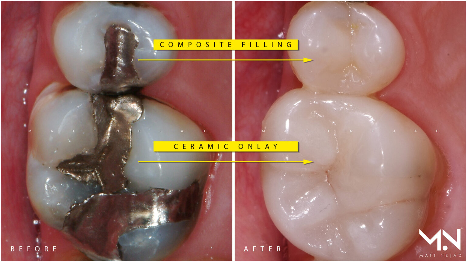 Replace Silver Fillings with Natural Biomimetic Restorations