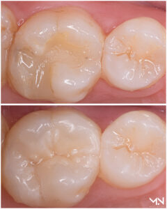 Biomimetic Dentistry Before and After Photos | Helm Nejad Stanley