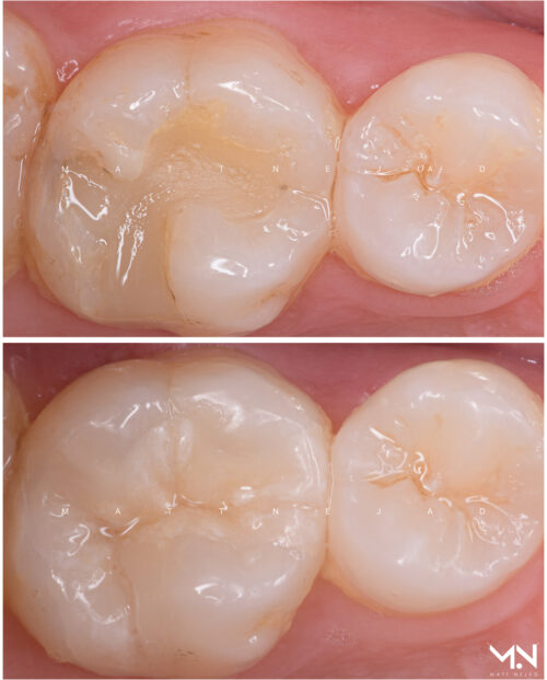 Biomimetic Dentistry Before and After Photos | Helm Nejad Stanley