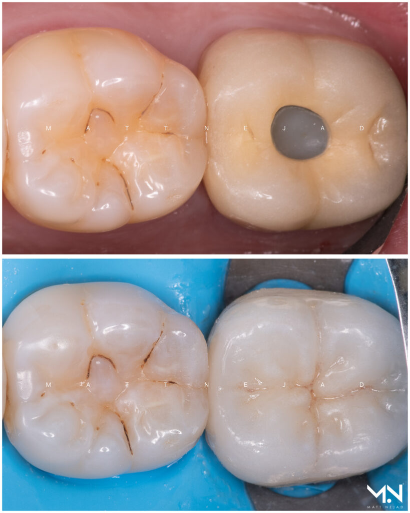 Biomimetic Dentistry Before and After Photos | Helm Nejad Stanley