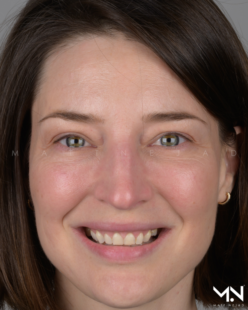 Before & After #5 - 10 Feldspathic Veneers Before & After #5 - 10 ...